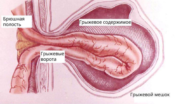 Пупочная грыжа у новорожденных: симптомы и лечение